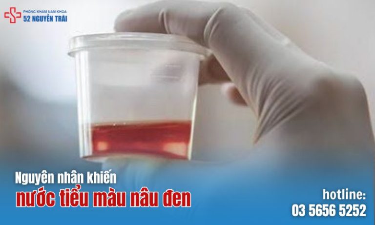 Nước tiểu màu nâu đen là bị gì? có phải vấn đề nguy hiểm hay không?